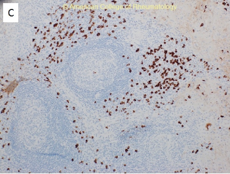 IgG4-Related Disease - Rheumatology for Primary Care