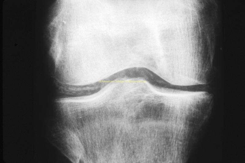 Crystalline Arthropathies - Rheumatology for Primary Care