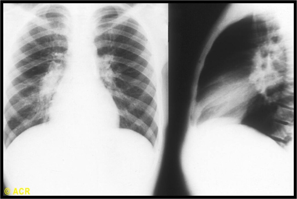 Sarcoidosis - Rheumatology for Primary Care