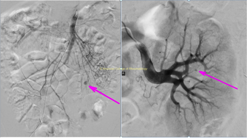 Polyarteritis Nodosa - Rheumatology for Primary Care