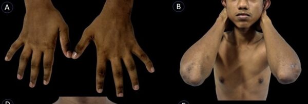 Juvenile Dermatomyositis - Rheumatology for Primary Care