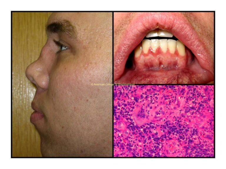 ANCA-Associated Vasculitis - Rheumatology for Primary Care